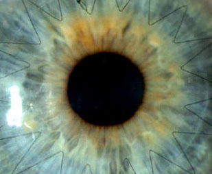 Prélèvement de cornées , un prélèvement méconnu