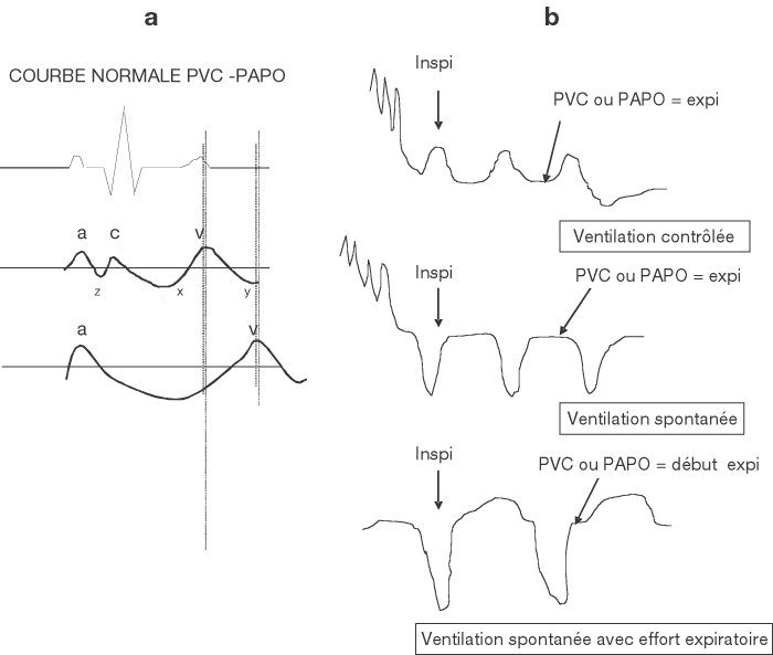 PVC : Pression veineuse centrale - Service de Réanimation Médicale ...