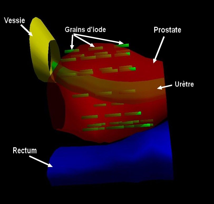 schéma_curie_prostate - Radiothérapie-Tenon