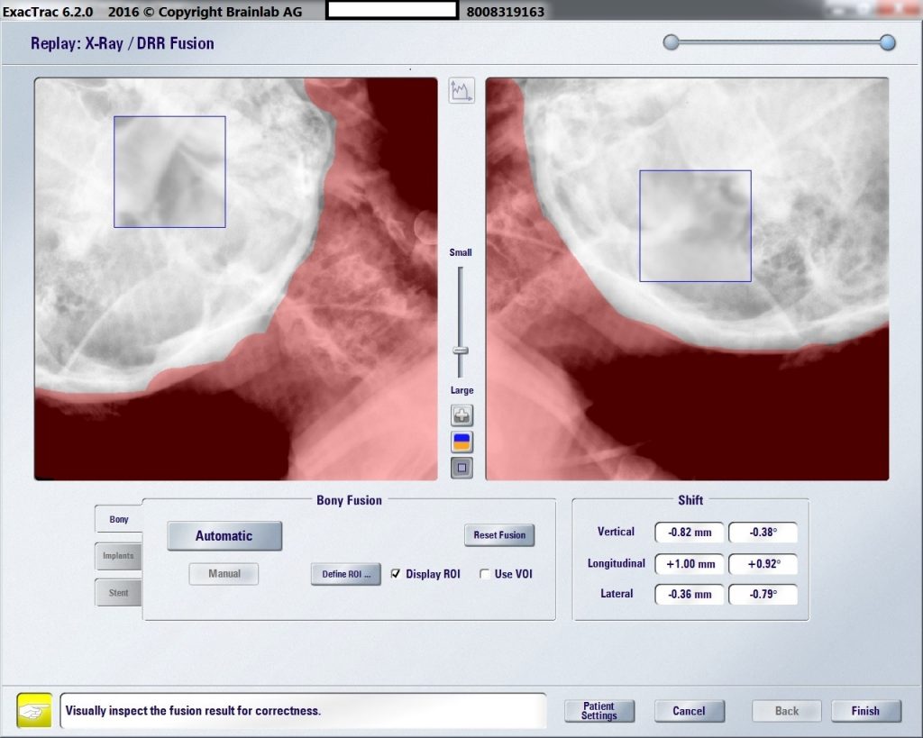 La radiothérapie stéréotaxique - Radiothérapie-Tenon