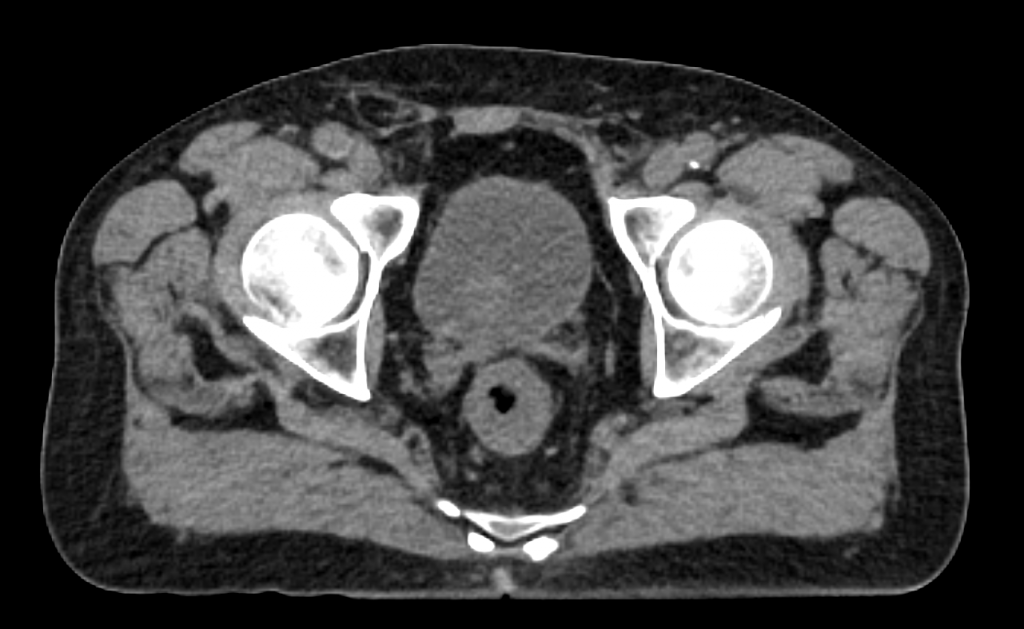 La simulation du traitement de radiothérapie - Radiothérapie-Tenon