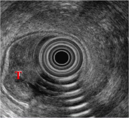 echo-endo-cancer-rectum - Service de chirurgie générale et digestive ...