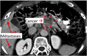 Cancer du pancréas - Service de chirurgie générale et digestive Hôpital ...